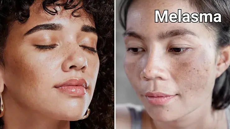 Melasma: The Complete Guide To Its Causes & Treatment – AccuFix Cosmetics