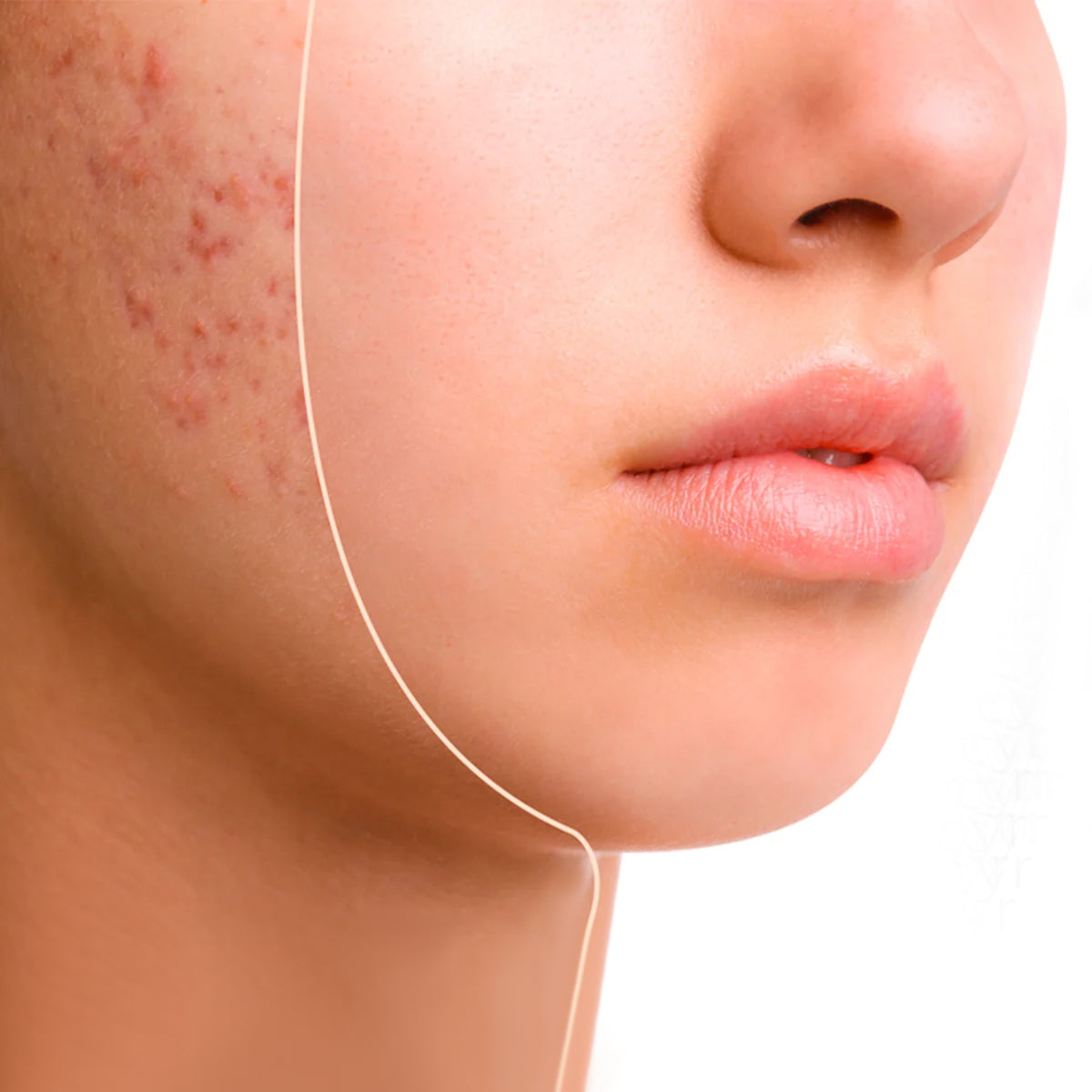 How to Get Rid of Pimples: Effective Acne Treatment – AccuFix Cosmetics