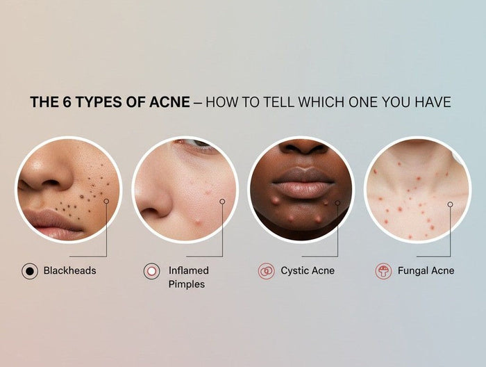 he 6 Types of Acne and How to Identify Yours | AccuFix Cosmetics